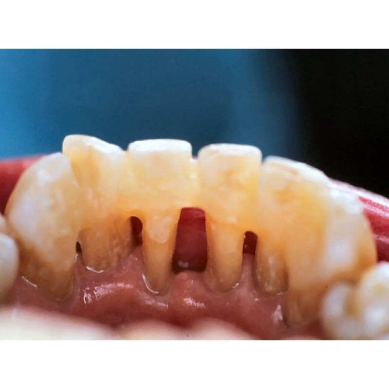 EVERSTICK PERIO 1 X 8 CM