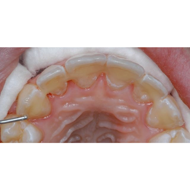 EVERSTICK ORTHO 2 X 12 CM