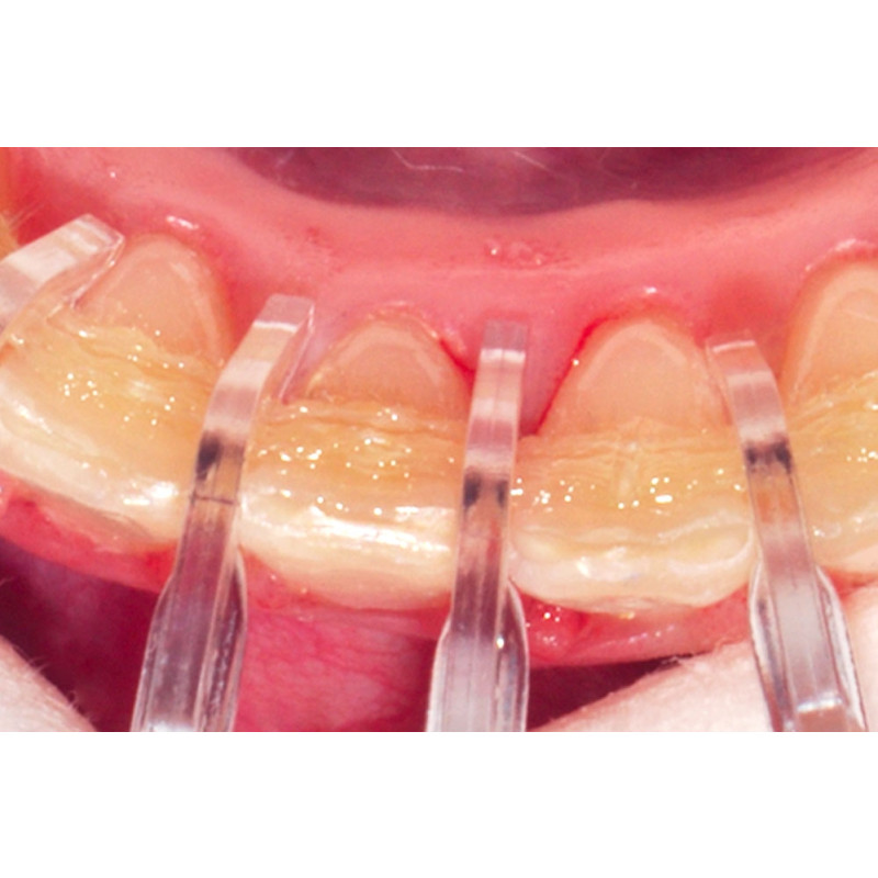 CLIP&SPLINT X30