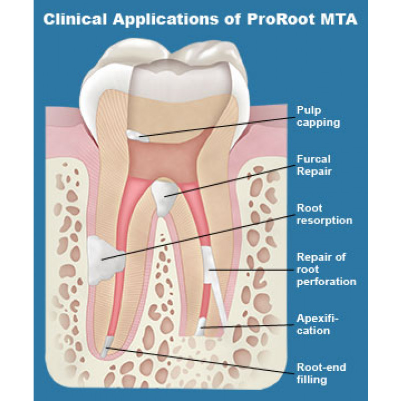 PRO ROOT MTA 4 X 0.5 GR.