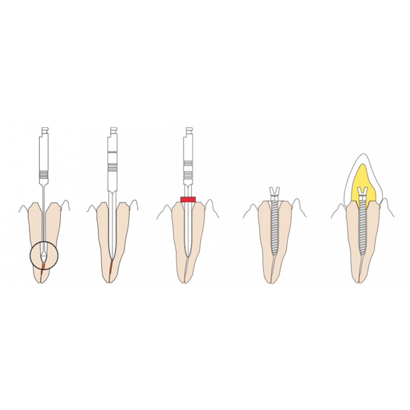 SURTEX SCREW POST TITANE X 15